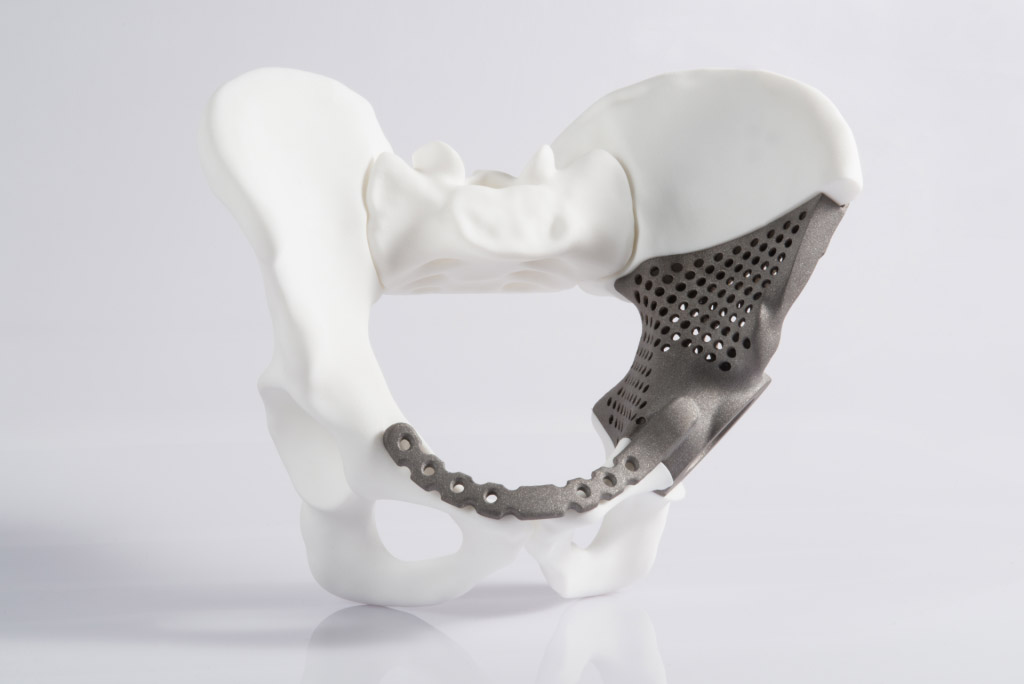 Today’s Medical Developments on custom made pelvis implant – Instrumentaria